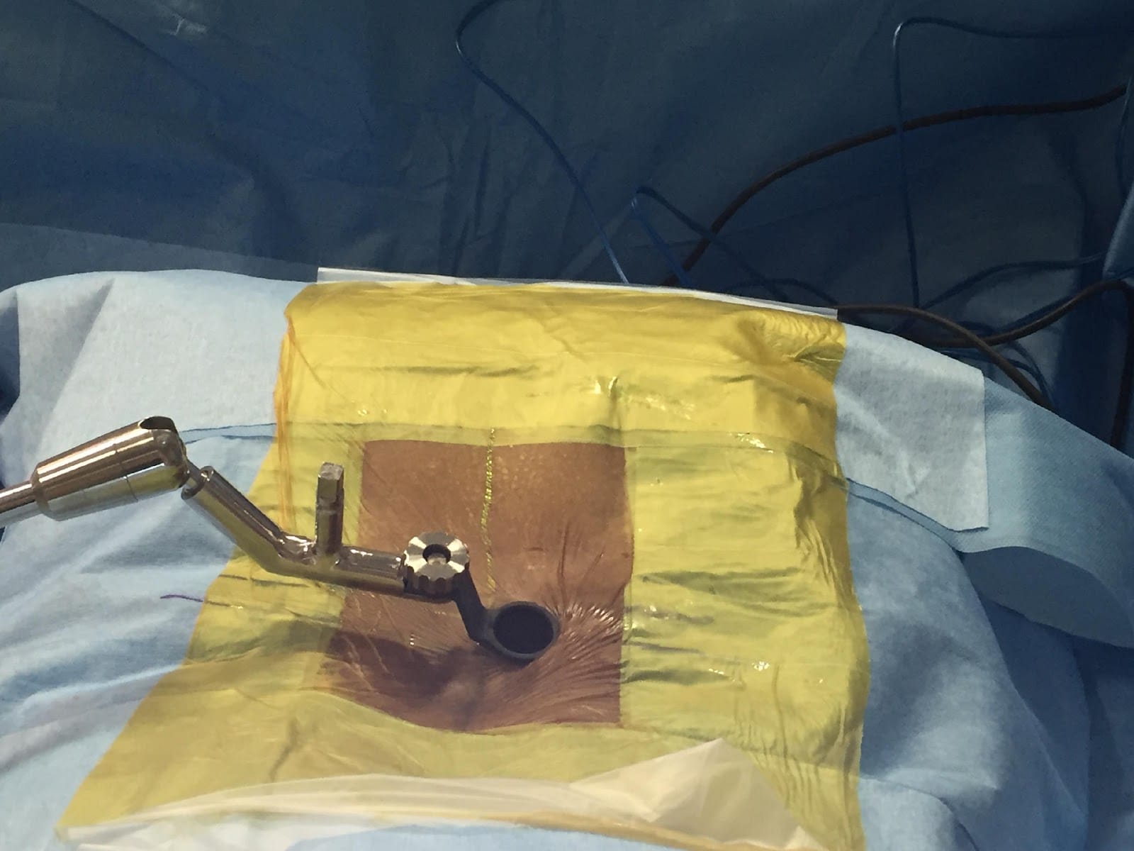 How Does Minimally Invasive Spine Surgery Work? | Spine 360