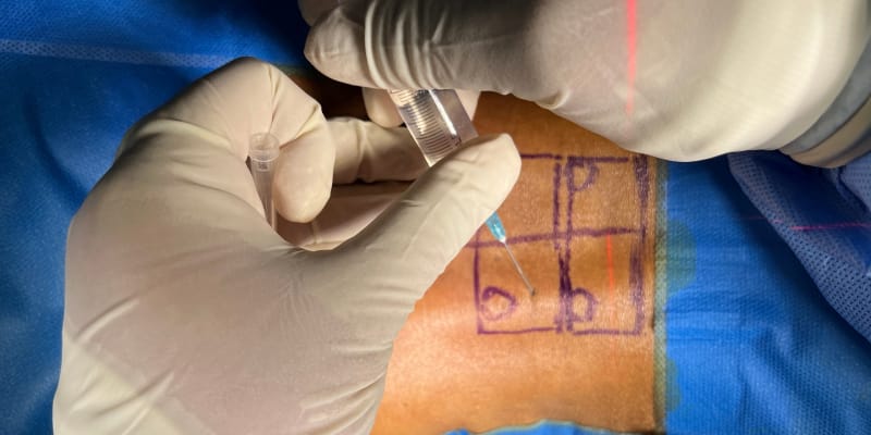 Injections Or Surgery For Herniated Disc: A Brief Guide