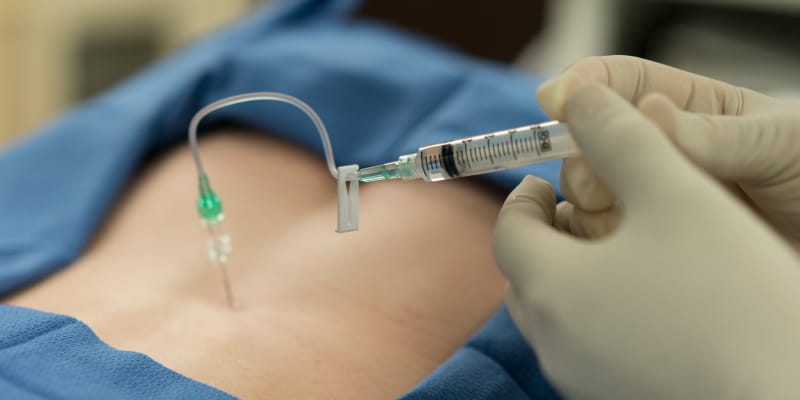 Epidural Injection Procedure: What To Expect